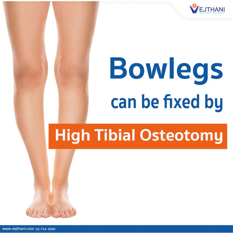 High Tibial Osteotomy by Vejthani Hospital
