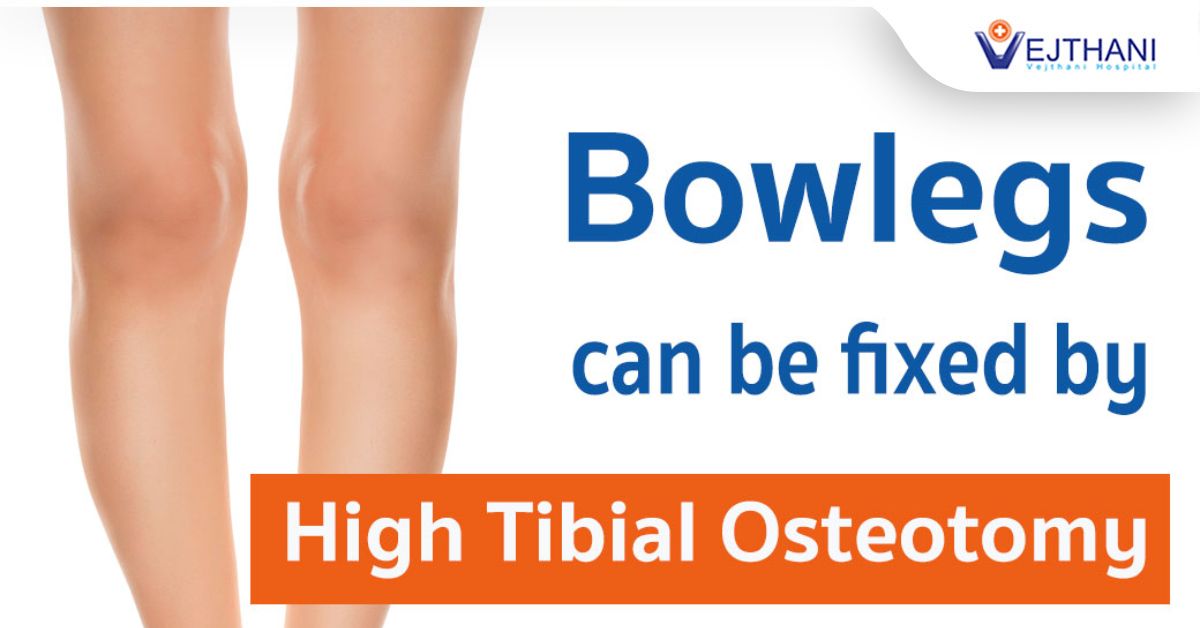High Tibial Osteotomy by Vejthani Hospital