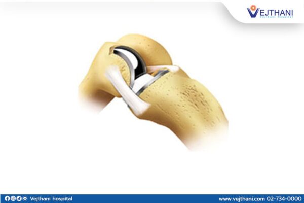 Unicompartmental Knee Arthroplasty