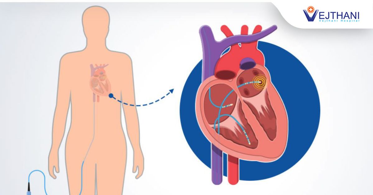 Radio Frequency Catheter Ablation