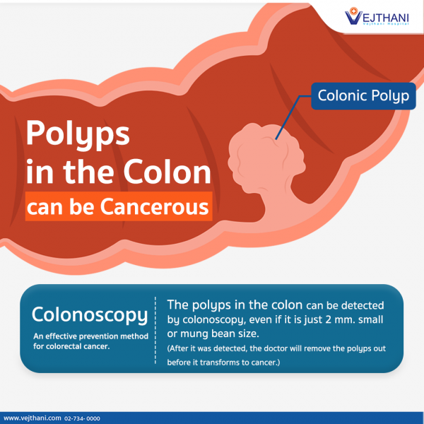 Polyps in the Colon can be Cancerous - Vejthani Hospital | JCI ...