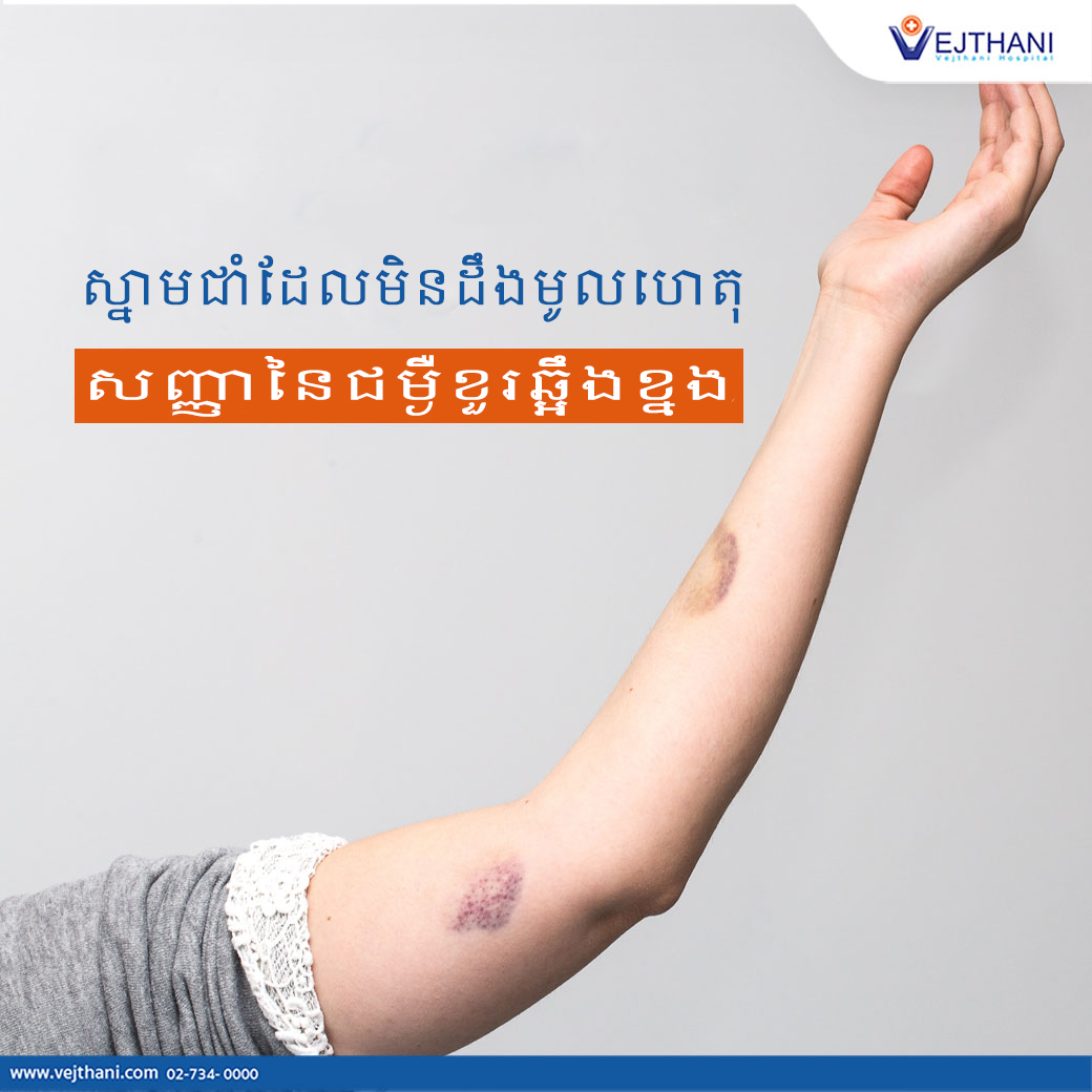 Unexplained Bruises: A Sign of Bone Marrow Defects - Vejthani Hospital