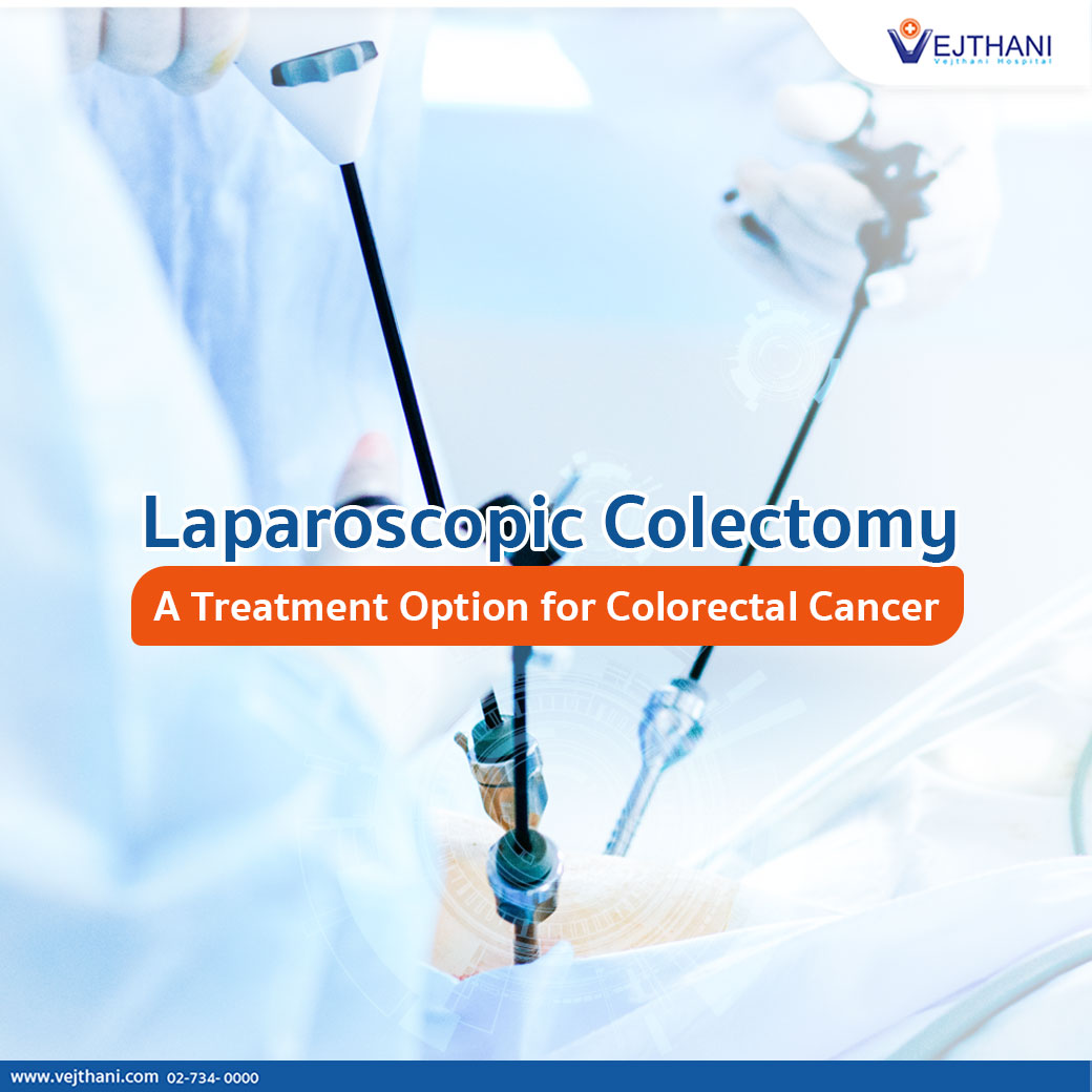 Laparoscopic colectomy, a treatment option for colorectal cancer