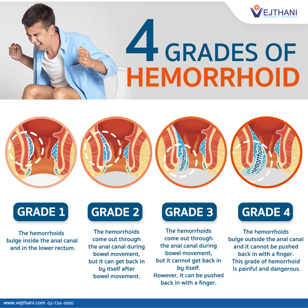 Hemorrhoid Hemorrhoid