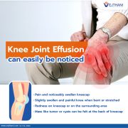 Symptoms of Knee Joint Effusion can easily be noticed