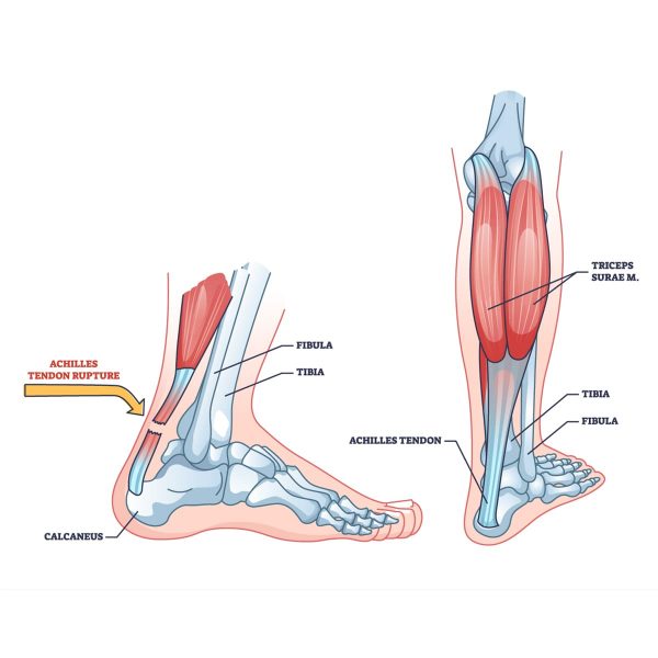 6 Ways to Identify Achilles Tendon Rupture | Vejthani