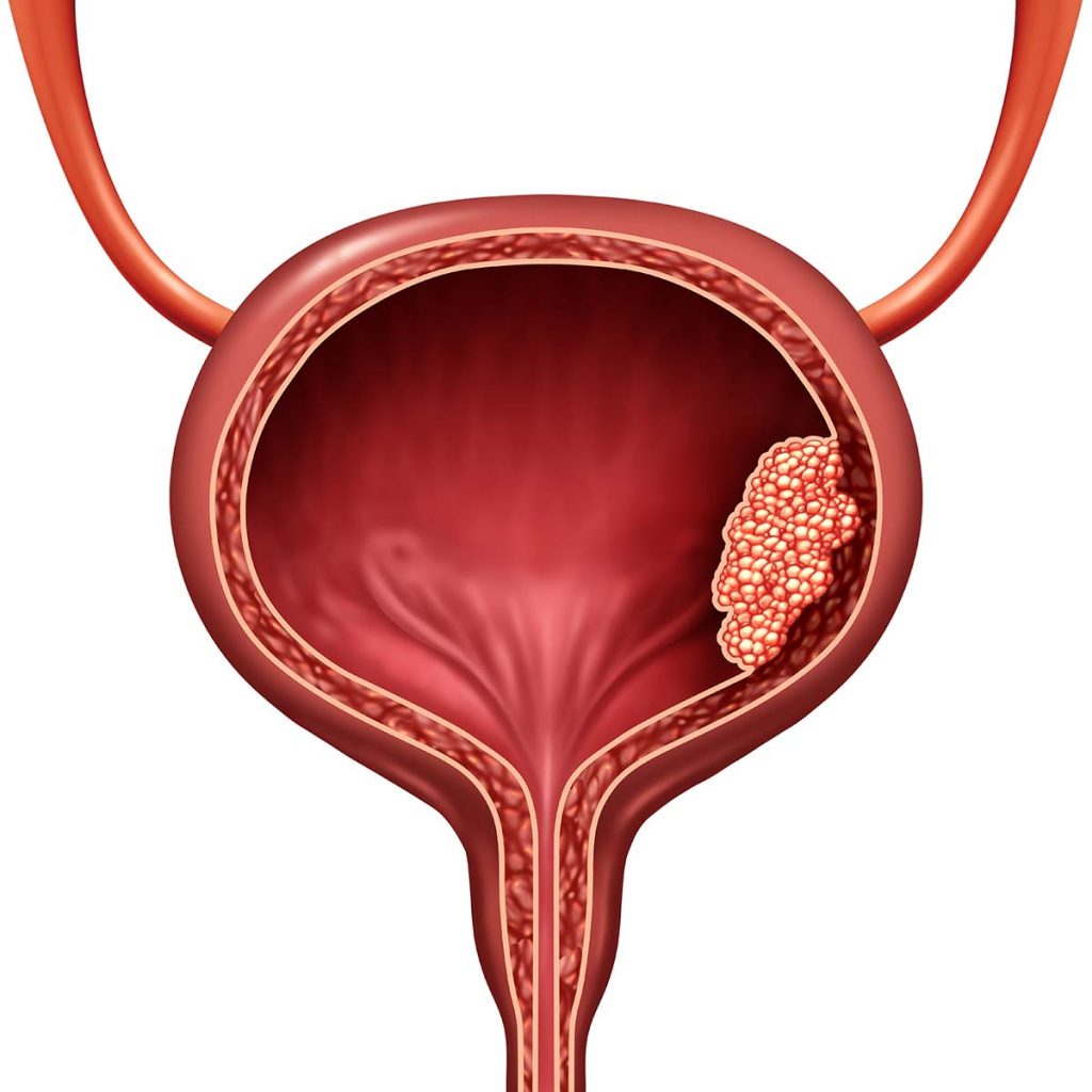 4 Key Bladder Cancer Symptoms and Risks | Vejthani