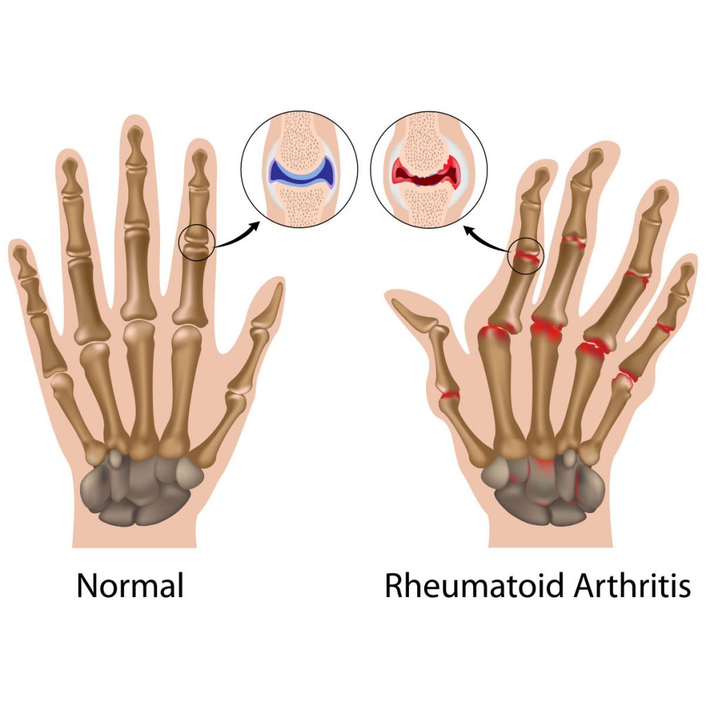 Rheumatoid Arthritis
