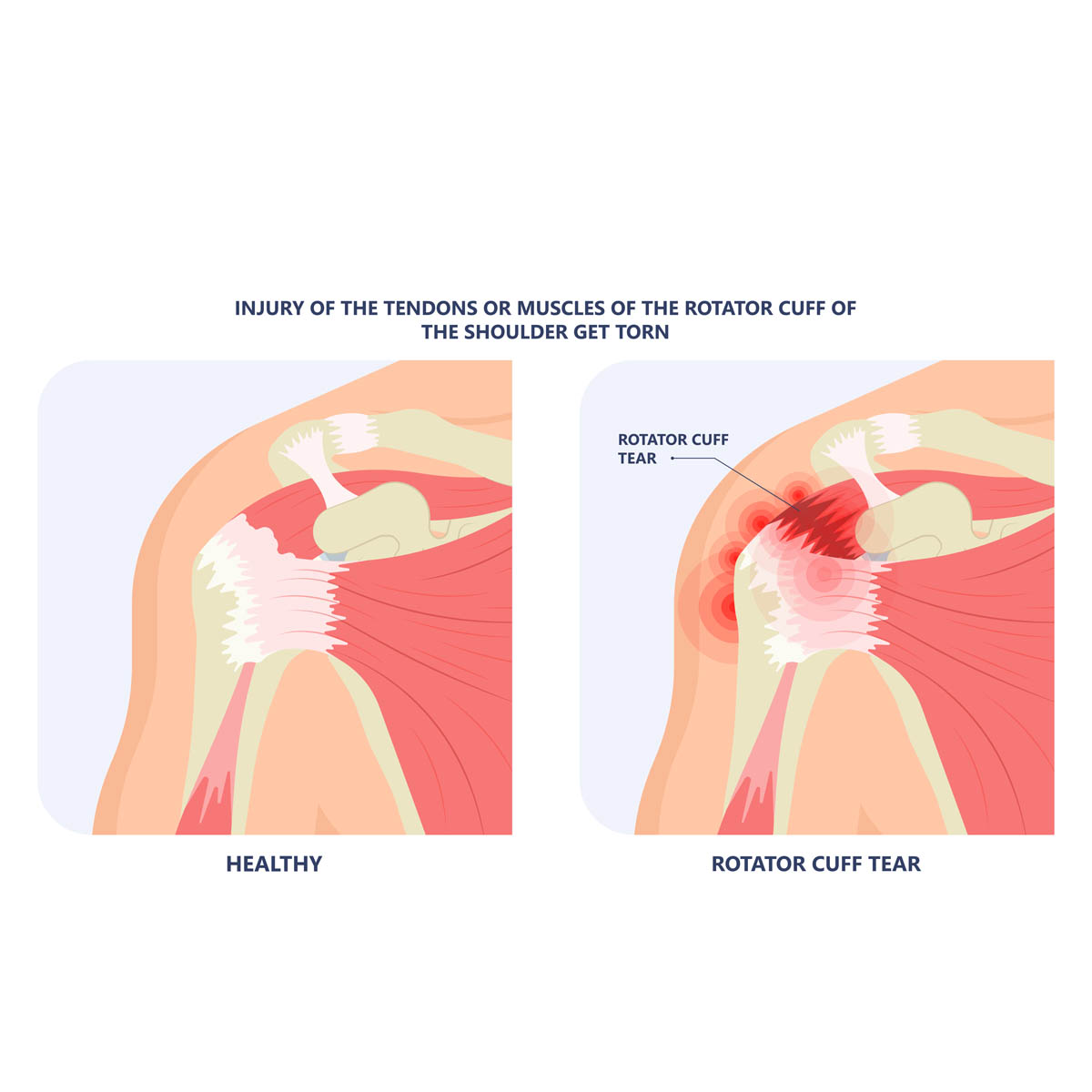 Rotator Cuff Injury: 7 Signs and Effective Care | Vejthani
