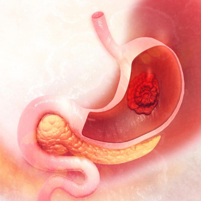 Stomach cancer - Vejthani International Hospital | JCI Accredited ...