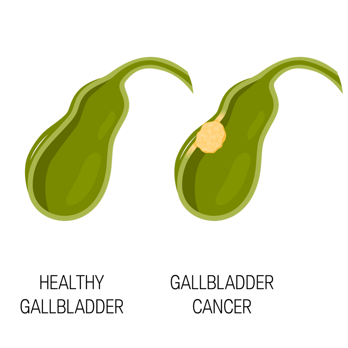 Gallbladder Cancer: Top Symptoms & Risks in 2024 | Vejthani