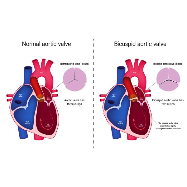 8 Common Symptoms For Aortic Valve Regurgitation | Vejthani 8 Common Symptoms For Aortic Valve Regurgitation | Vejthani