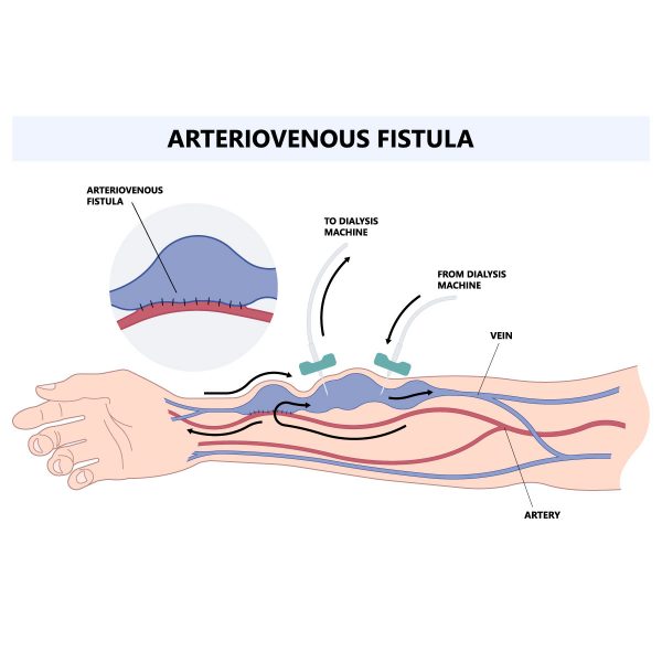 2024 Guide: Arteriovenous Fistula Causes & Cares -友软网络