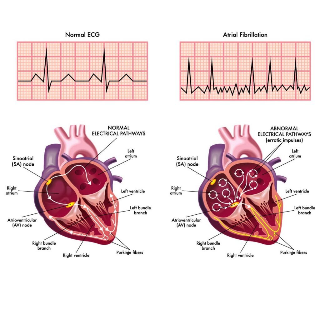 Top 12 Atrial Fibrillation Causes And Symptoms Vejthani