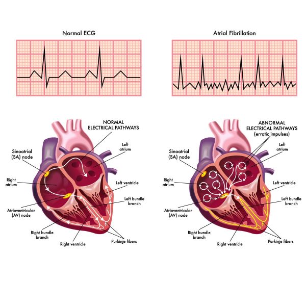 Top 12 Atrial Fibrillation Causes And Symptoms | Vejthani