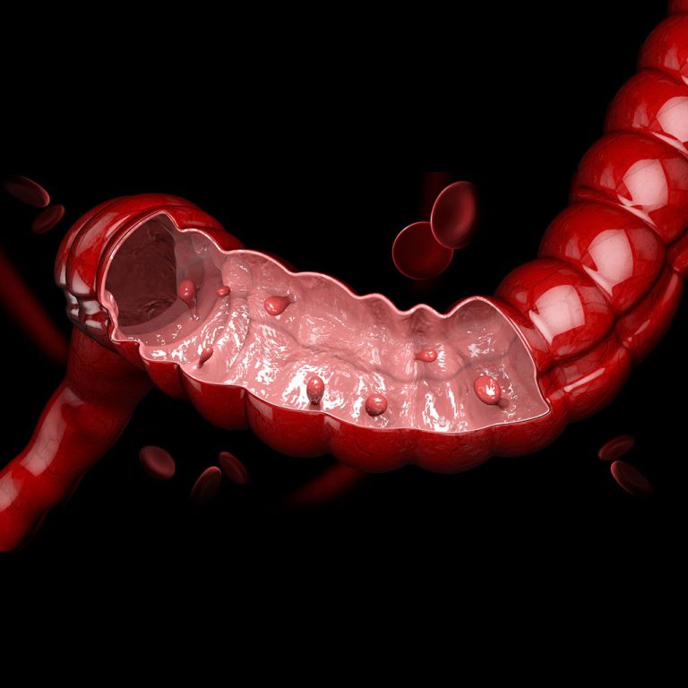 Colon Polyp Risks And Key Symptoms At Age 45 Vejthani