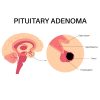 Spot the Symptoms of Pituitary Tumors | Vejthani