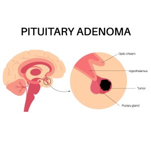 Spot the Symptoms of Pituitary Tumors | Vejthani