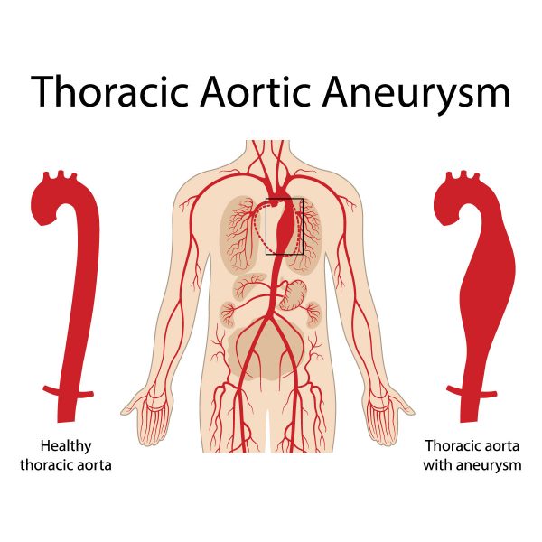 10 Warning Signs Of An Aortic Aneurysm | Vejthani