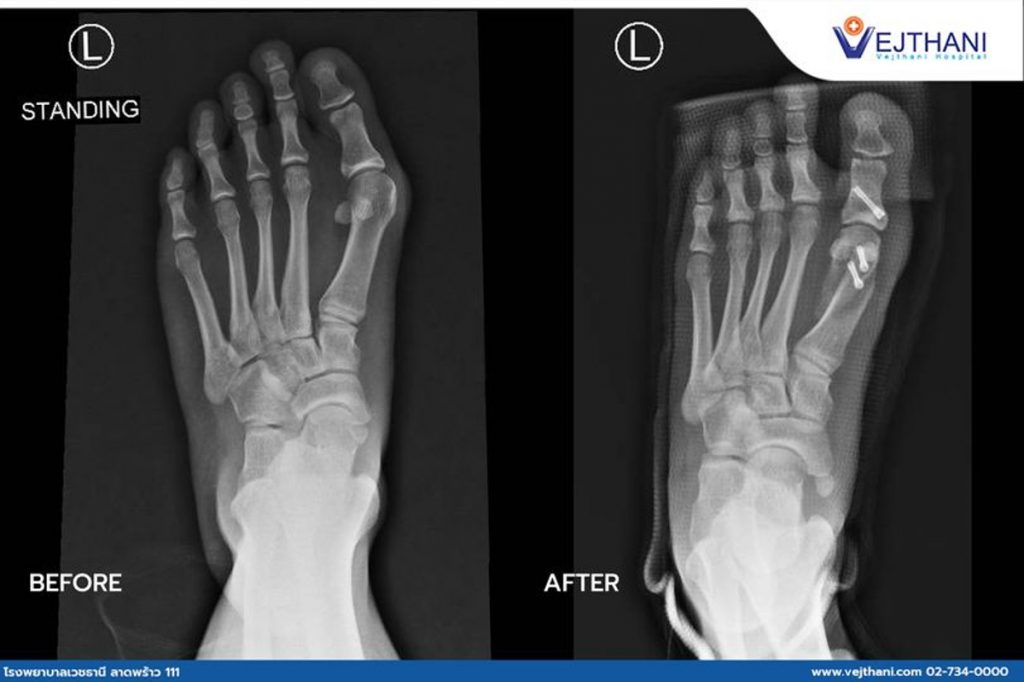 Beauty is Pain: “Toe Deformities” could be a Silent Threat to working ...