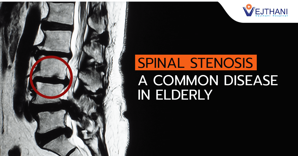 Spinal Stenosis Symptoms Causes And Effective Treatment Options