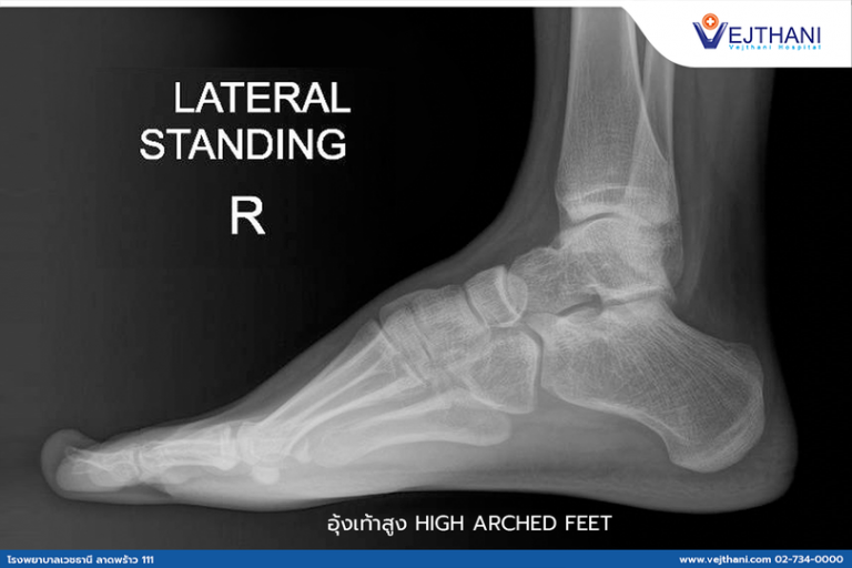 What does “High Arched Feet” look like?