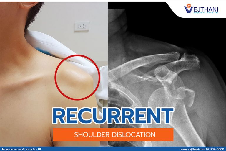 “Recurrent Shoulder Dislocation” is Treatable