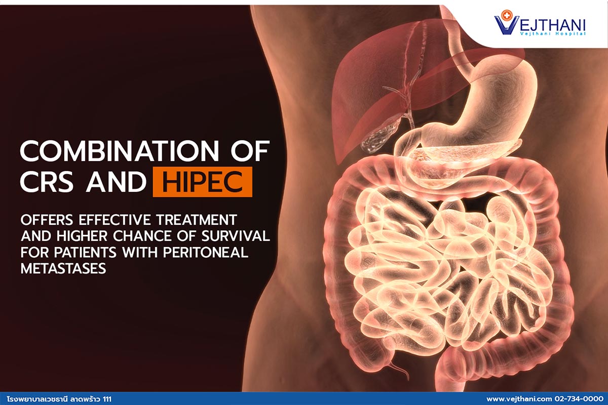 Combination of CRS and HIPEC offers Effective Treatment and Higher ...