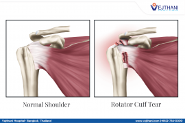 Treatment Methods for Rotator Cuff Tears