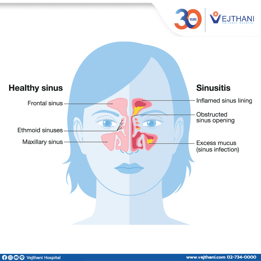 Chronic Sinusitis Vejthani Hospital Jci Accredited International