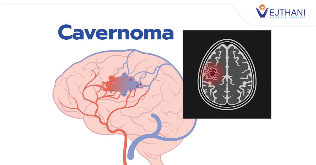 What is a Cavernous Hemangioma?