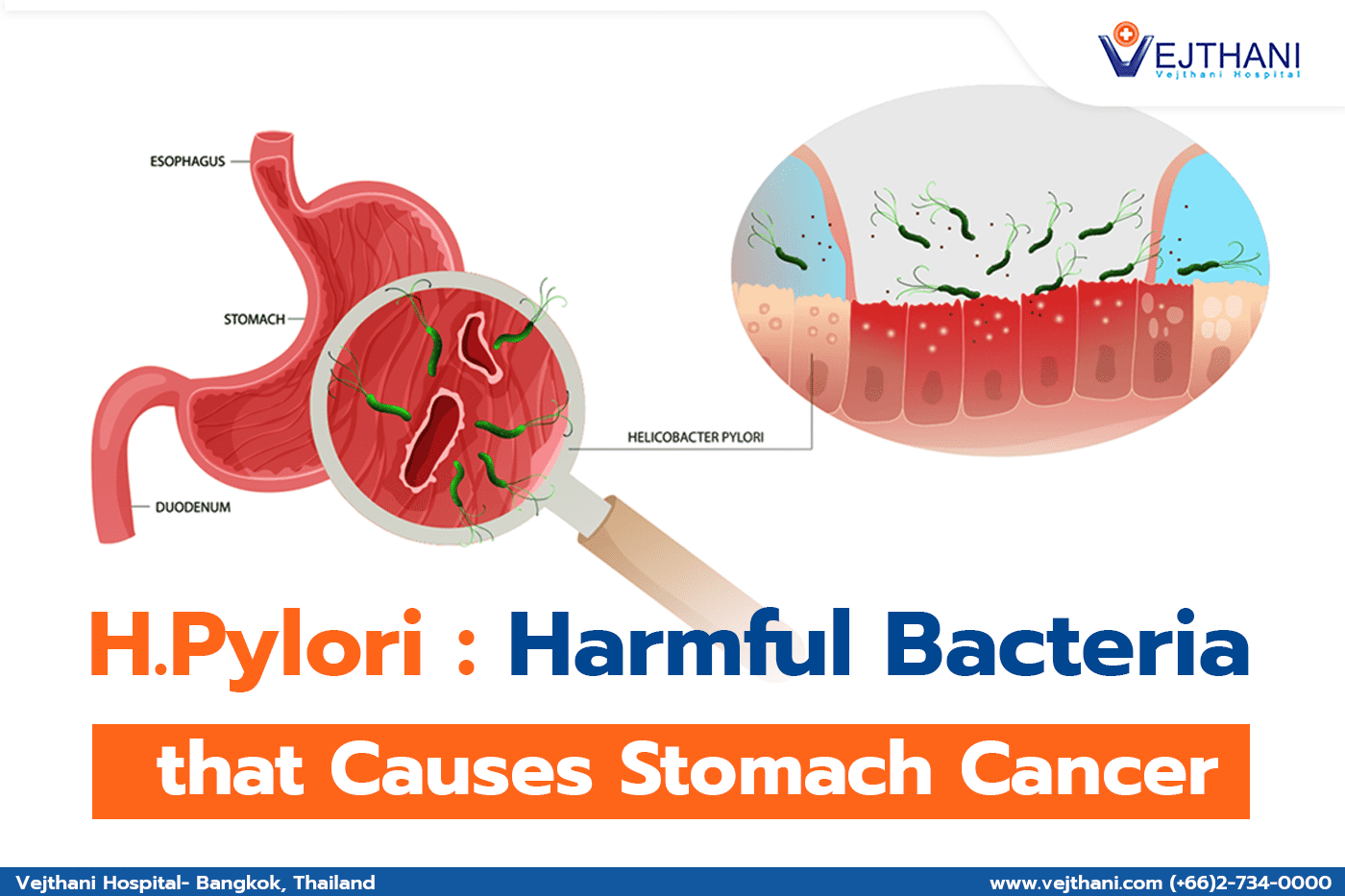 H.Pylori: Harmful Bacteria that Causes Stomach Cancer - Vejthani ... H.Pylori: Harmful Bacteria that Causes Stomach Cancer - Vejthani ...