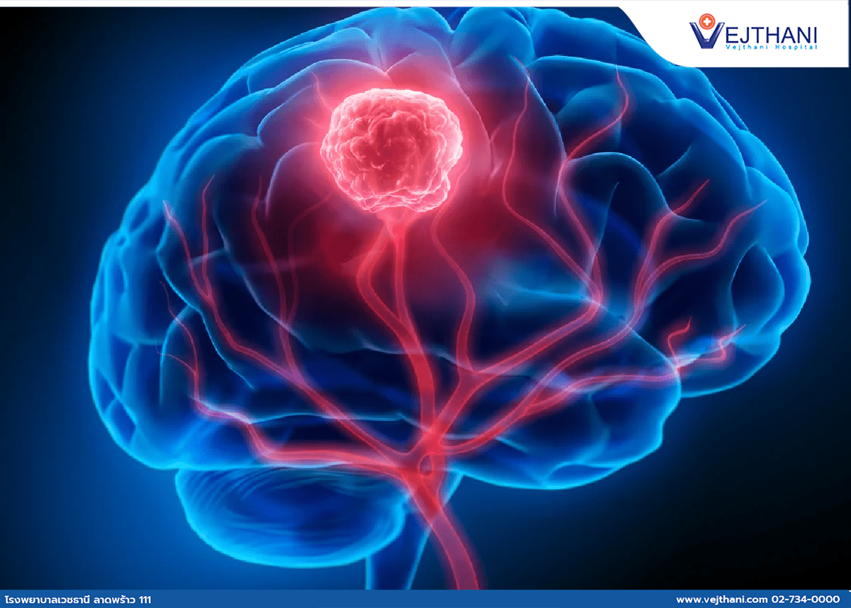 Biplane DSA ตัวช่วยในการผ่าตัดเนื้องอกในสมอง | Vejthani