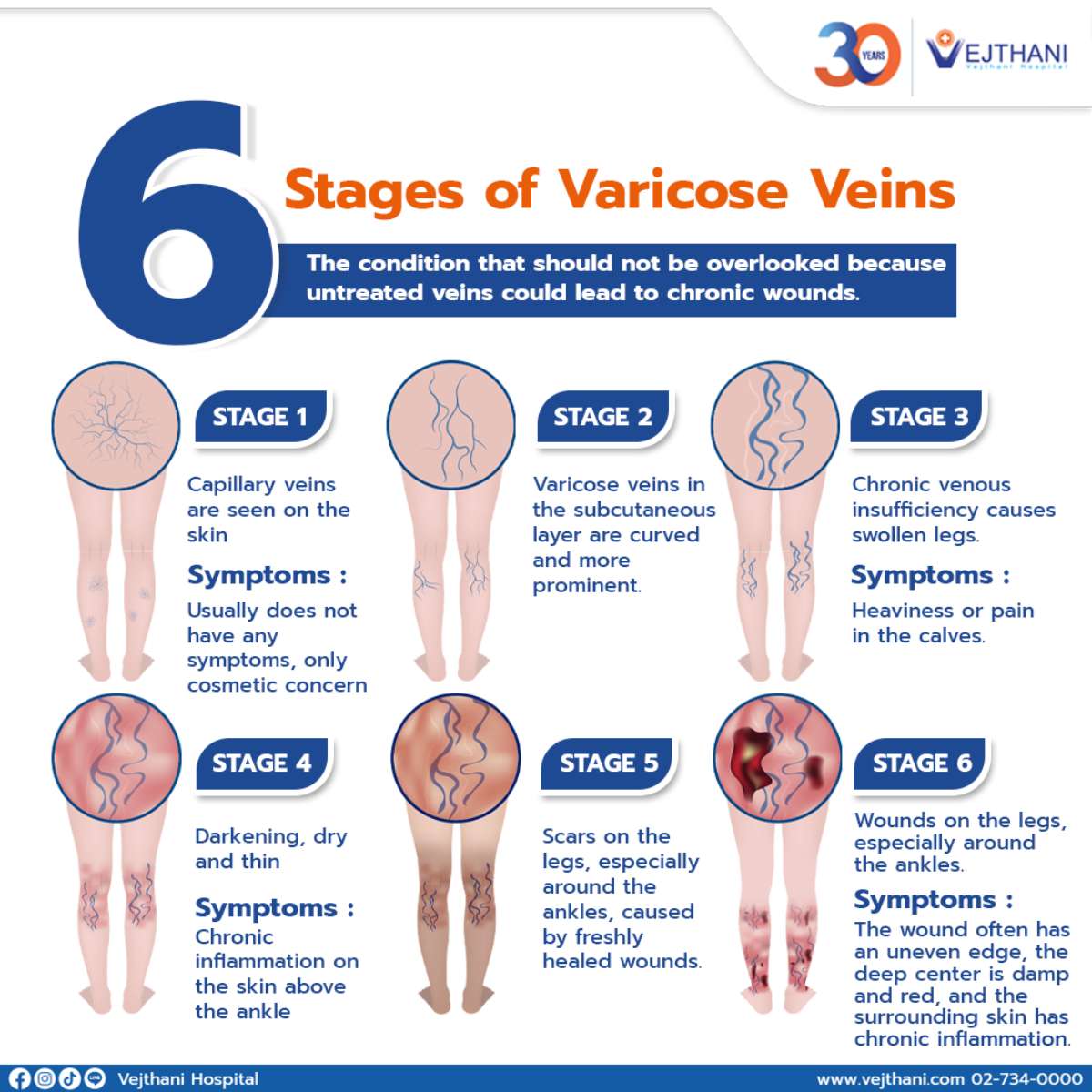 6 Stages of Varicose Veins and the Importance of Early Treatment