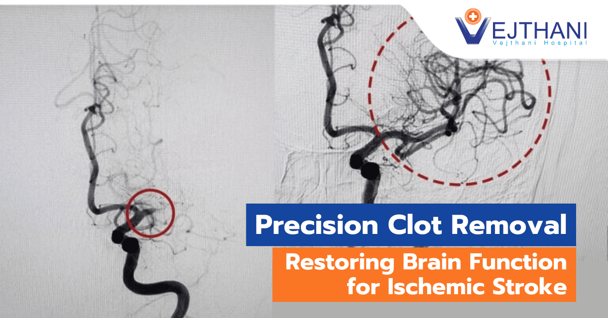Precision Clot Removal to Restore Brain Function in Ischemic Stroke ...