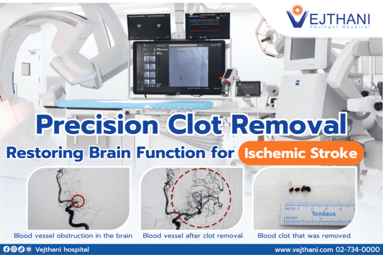 Precision Clot Removal to Restore Brain Function in Ischemic Stroke ...
